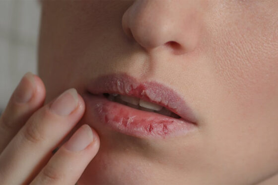How to Stop Bleeding Lips | Causes and DIY methods – Banish The Beige